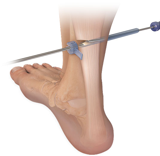 Soft Tissue Repair - Lavender Medical