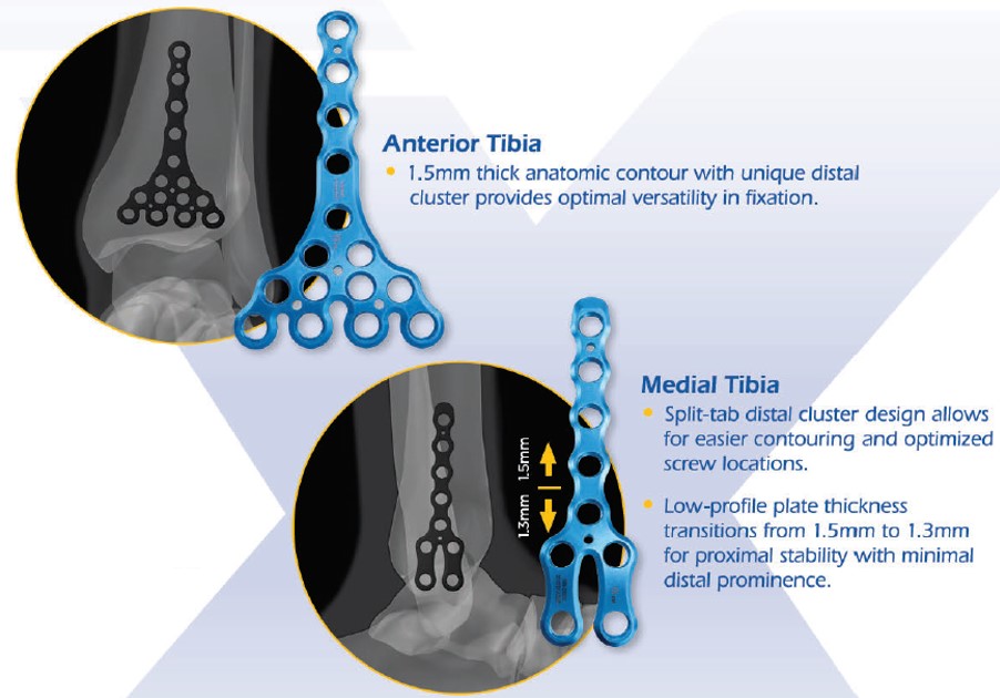 Omni Ankle Fracture Plating System - Lavender Medical