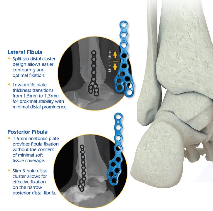 Omni Ankle Fracture Plating System - Lavender Medical
