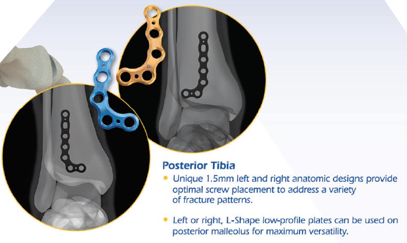 Omni Ankle Fracture Plating System - Lavender Medical