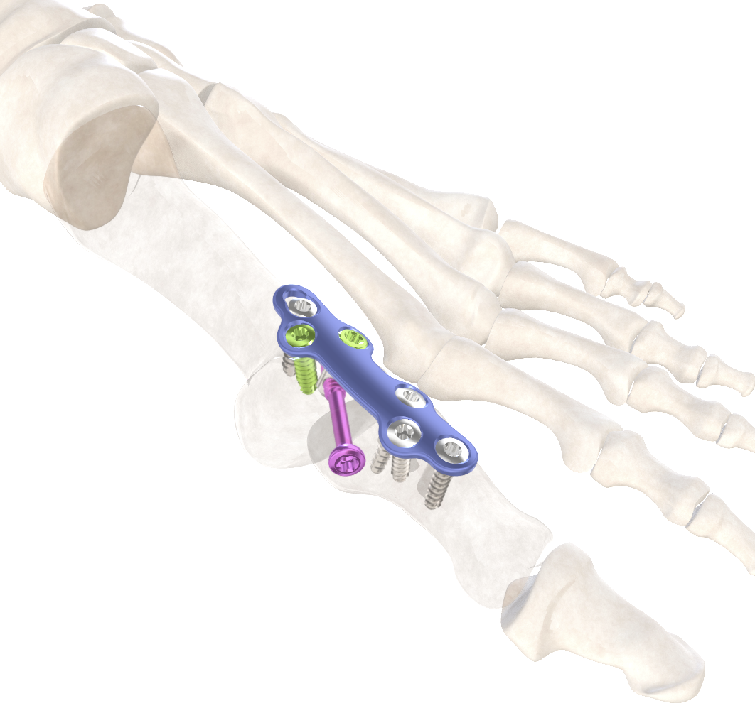 Omni Universal - Foot Plating - Lavender Medical
