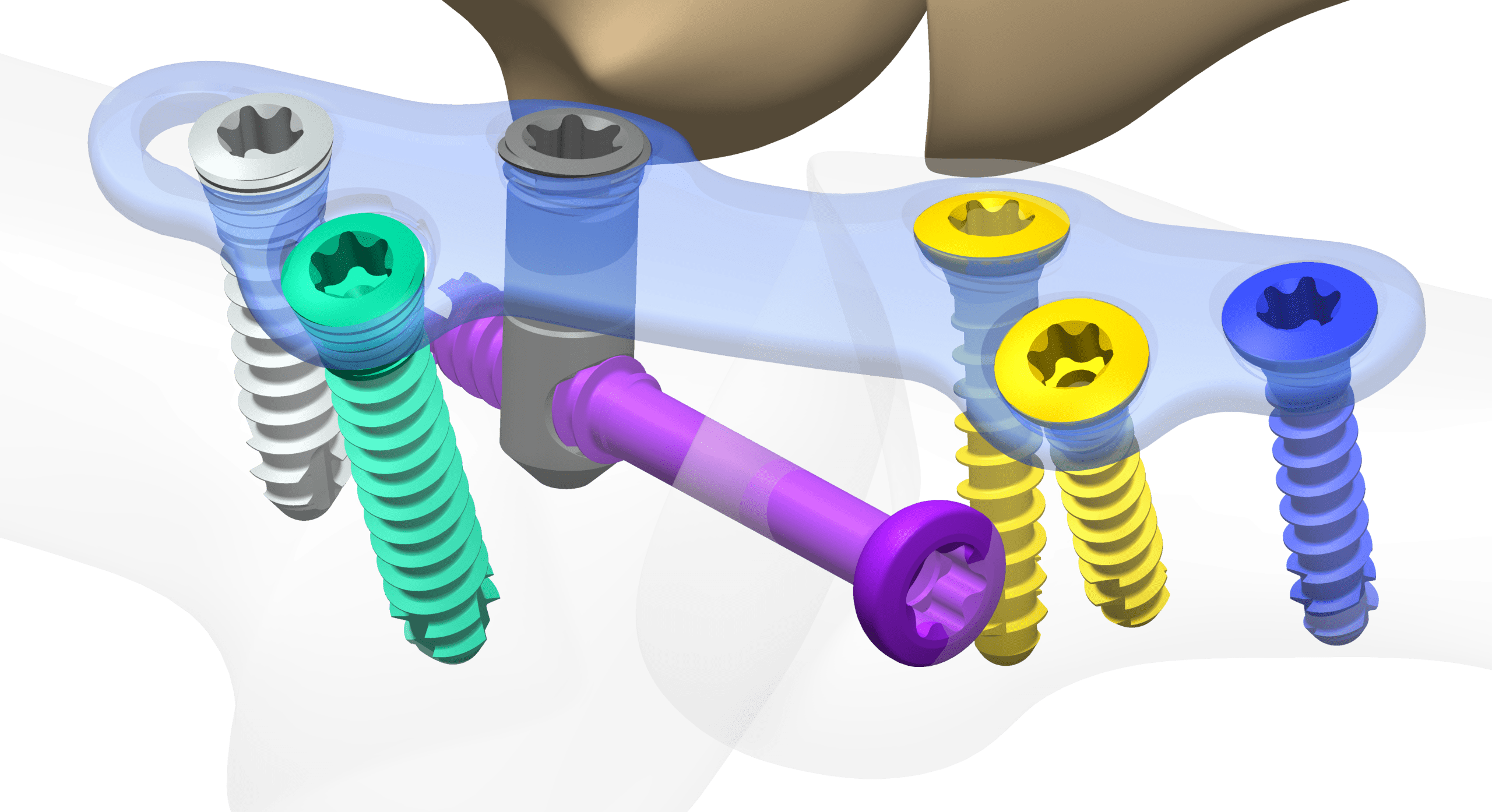 Omni Universal - Foot Plating - Lavender Medical